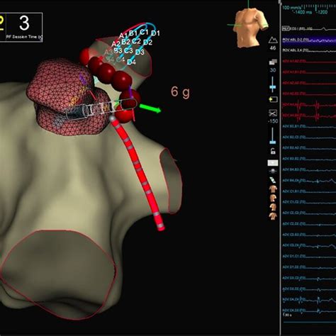 High Power Short Duration Pulmonary Vein Isolation With The Novel Download Scientific Diagram