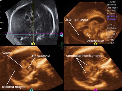 Cisterna Magna Ultrasound