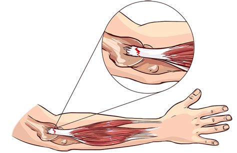 Extensor Tendonitis Elbow
