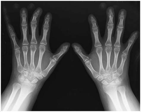 Radiographs Of Hands Note Mild Shortening Of The Fifth Metacarpal Of Download Scientific