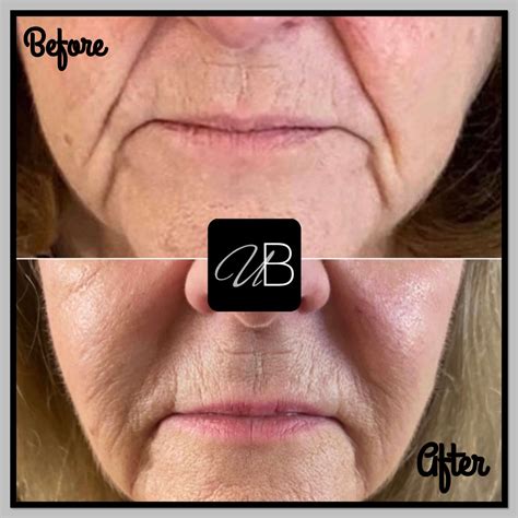 Nasolabial Lines What Are They