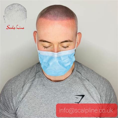 Scalp Line Scalp Micropigmentation A Cosmetic Tattoo Designed To