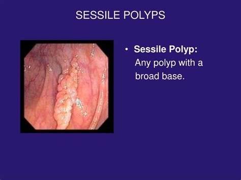 Sessile Polyp