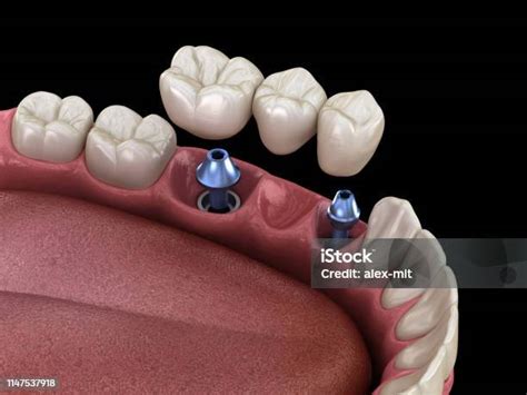 임 플 란 트가 지 원하는 치과 교량 인간의 치아와 의치 개념의 의학적으로 정확한 3d 그림 0명에 대한 스톡 사진 및 기타 이미지 Istock