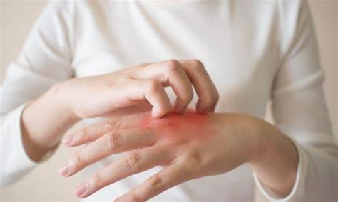 World Atopic Eczema Day More Than Skindeep Longevity