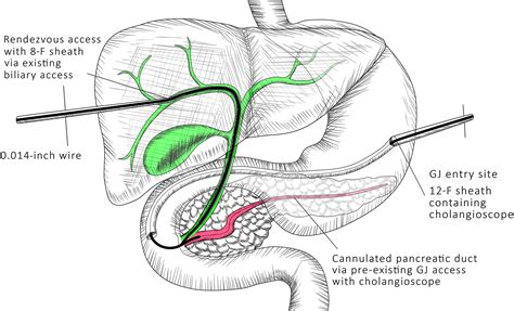 Percutaneous Cholangioscopy Assisted Placement Of A Pancreatic Duct Stent Using Biliary And Percutaneous Cholangioscopy Assisted Placement Of A Pancreatic Duct Stent Using Biliary And