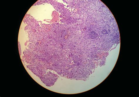 Firm Nodular Swelling Over The Scalp Figure 2 Squamous Cell Carcinoma Download Scientific Diagram