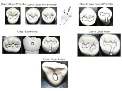 Class I Cavity Prep1