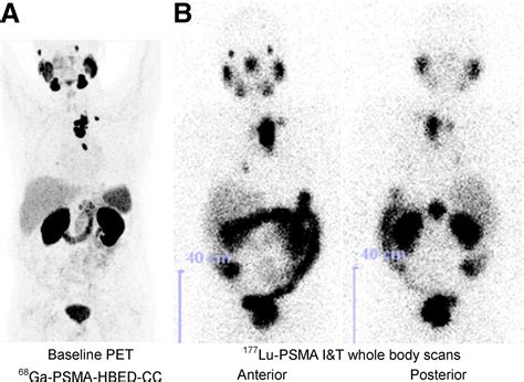 68ga And 177lu Labeled Psma Iandt Optimization Of A Psma Targeted