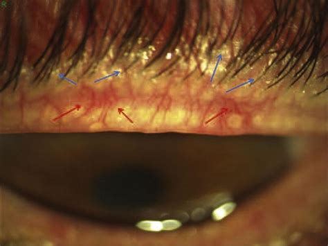 Angular Blepharitis
