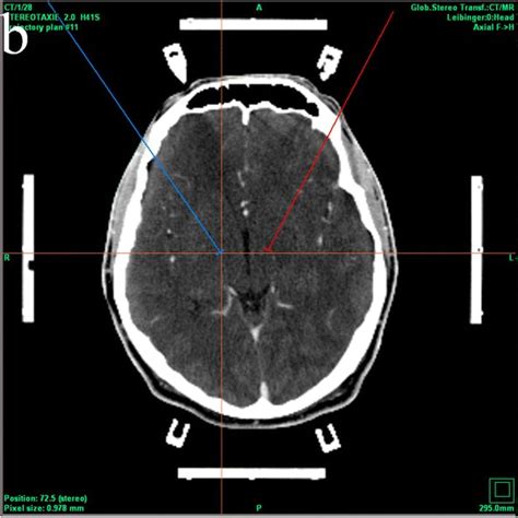 Co Registration Of Intraoperative Stereotactic X Ray Image A With Download Scientific Diagram