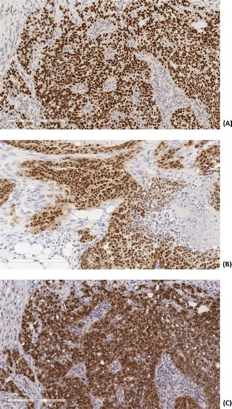 Immunohistochemical Staining A Wt1 Nuclear Staining In The Majority