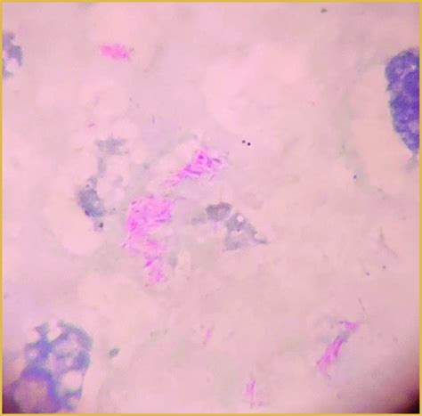 Slit Skin Smear Showing Acid Fast Bacilli Pink In A Bluish Background Download Scientific