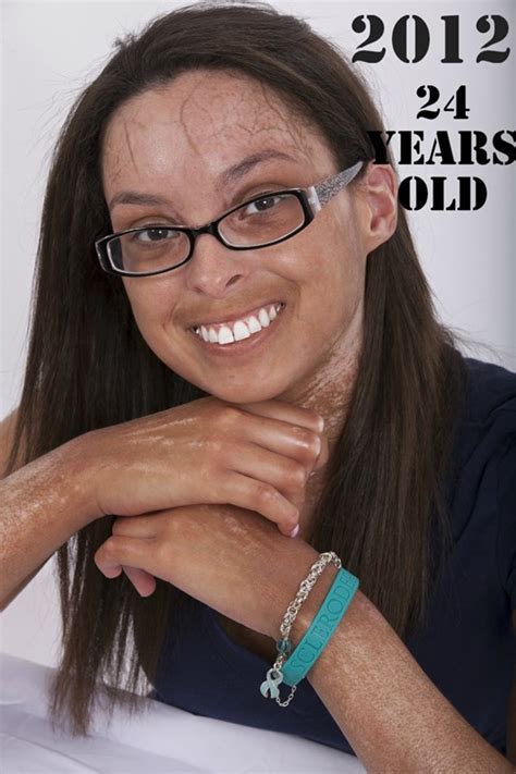 A Day In The Life Of The Tube Fed Wife Scleroderma Awareness Month