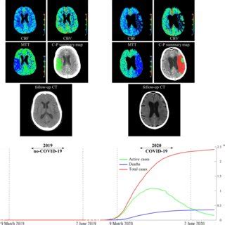 Comparison Between CT Perfusion And Follow Up CT During COVID 19 And Download Scientific