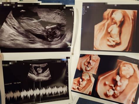 임신 12주차 기형아검사 입체초음파 성별 네이버 블로그