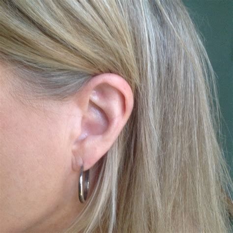 One Week After Activation A Cochlear Implant Diary