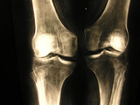 Rheumatologe Chondrocalcinosis