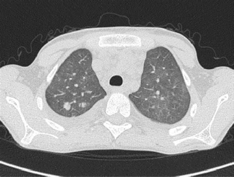 Diffuse Pulmonary Nodules In Upper Lobes Download Scientific Diagram
