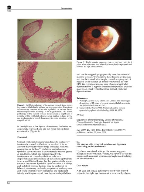 Pdf Iris Naevus With Recurrent Spontaneous Hyphema Simulating An Iris