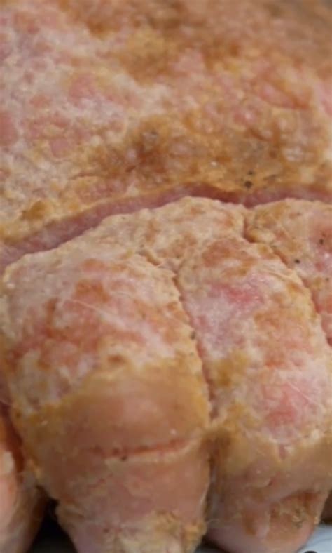 Woman With Maggots In Between Her Toes Says She S Devastated After Being Sent Home From