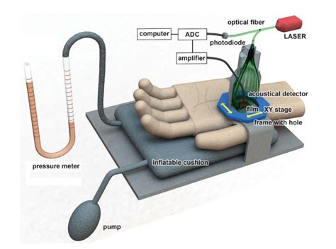 Volumetric Quantification Of Skin Microcirculation Disturbance Induced