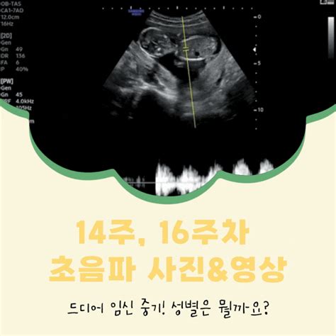 임신 14주 16주 초음파 뇌물혹 2차기형아검사 심장소리 네이버 블로그