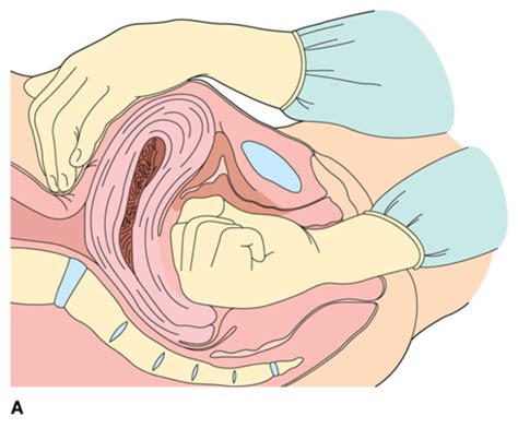 Postpartum Complications Flashcards Quizlet