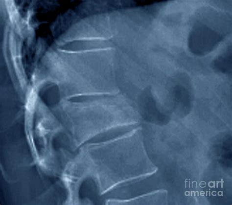 Fractured Lumbar Vertebra Photograph By Zephyrscience Photo Library Fine Art America