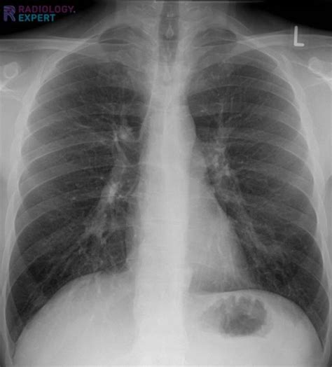 Chest X Ray Icu
