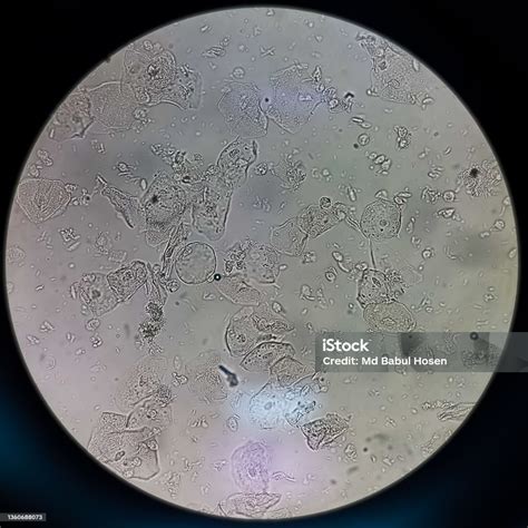 Sel Epitel Dengan Bakteri Dalam Urin Pasien Dianalisis Dengan Mikroskop