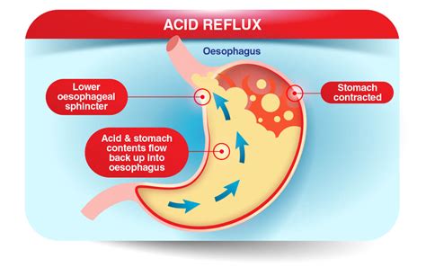 Gastricell For Gastric And Acid Reflux Labo Nutrition