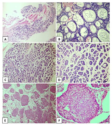 Adenoid Cystic Carcinoma Tubular Pattern At Ryan Hannum Blog