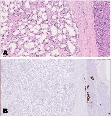 A Resected Specimen Showing Microcystic Serous Cystadenoma Normal