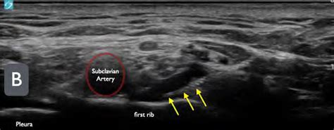 Supraclavicular Lymphadenopathy Ultrasound