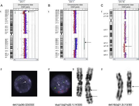 Comparative Genomic Hybridisation As A First Option In Genetic Diagnosis 1000 Cases And A Cost