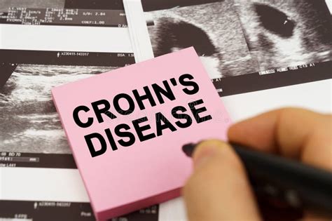On The Ultrasound Pictures There Are Stickers That Say Crohns Disease Stock Image Image Of