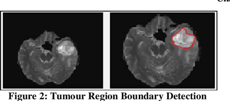 Figure 2 From An Automated Brain Tumour Boundary Detection Using Region