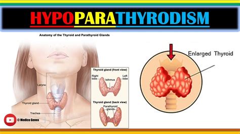 Hypoparathyroidism Causes Of Hypoparathyroidism Symptoms Of Hypoparathyroidism Thyroid