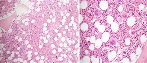 Histopathological Examination Of The Bone Marrow A Hypercellular Bone