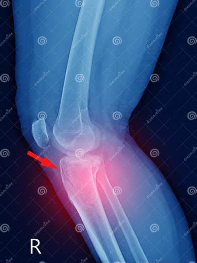 X Ray Knee Fracture Proximal Metaphysis Of Tibia Depressed Fracture Of Lateral Tibial Plateau
