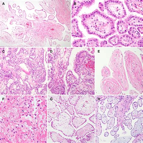 Clinicopathological Characteristics Of Well Differentiated Papillary