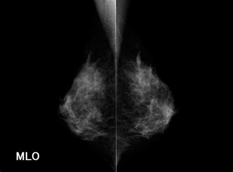 マンモグラフィ検査乳房撮影検査、mmg｜中央放射線部｜部門紹介｜診療部・部門紹介｜｜地方独立行政法人三重県立総合医療センター Mie