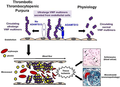 Thrombotic Thrombocytopenic Purpura Pathophysiology