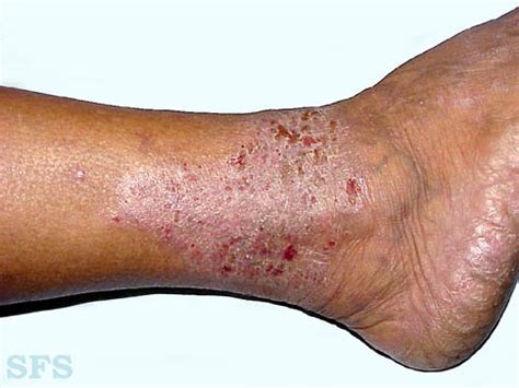 Venous Stasis In The Legs Symptoms With Eczema And Ulcer Pictures
