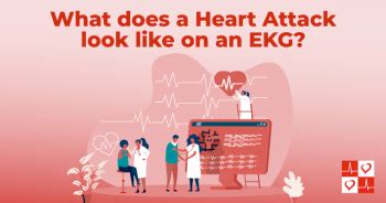 What Does A Heart Attack Look Like On An Ekg Cardiacdirect