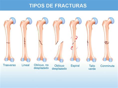¿te Quebraste DÓnde CÓmo Dr Sebastian Silva Muñoz