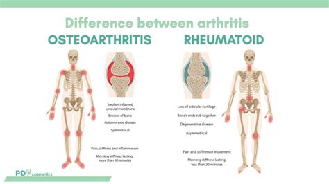 Difference Between Osteoarthritis And Rheumatoid Arthritis Pdcosmetics