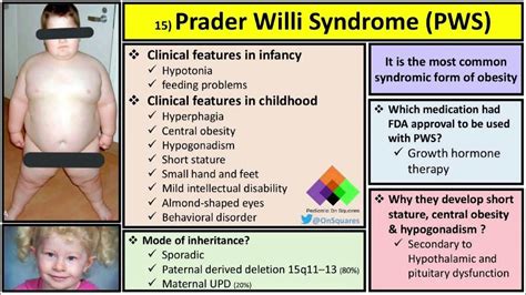 Prader Willi Syndrome Causes Risks Clinical Features Diagnosis