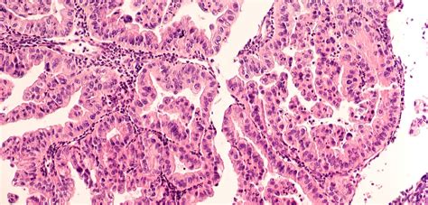 Accurate Predictions Of Ovarian Cancer Outcome Possible With New